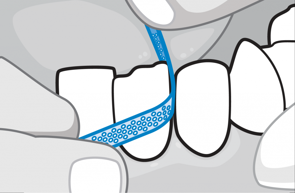 What is IPR? | Rock Creek Dental