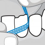 What is IPR? | Rock Creek Dental