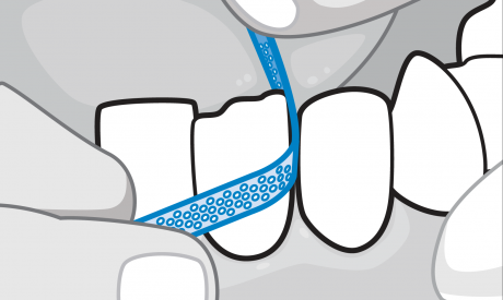 What is IPR? | Rock Creek Dental