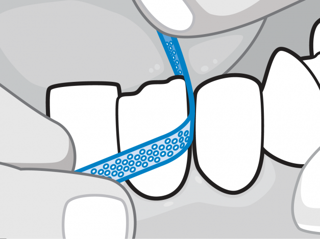 What is IPR? | Rock Creek Dental