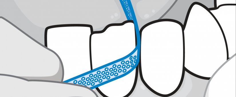 What is IPR? | Rock Creek Dental